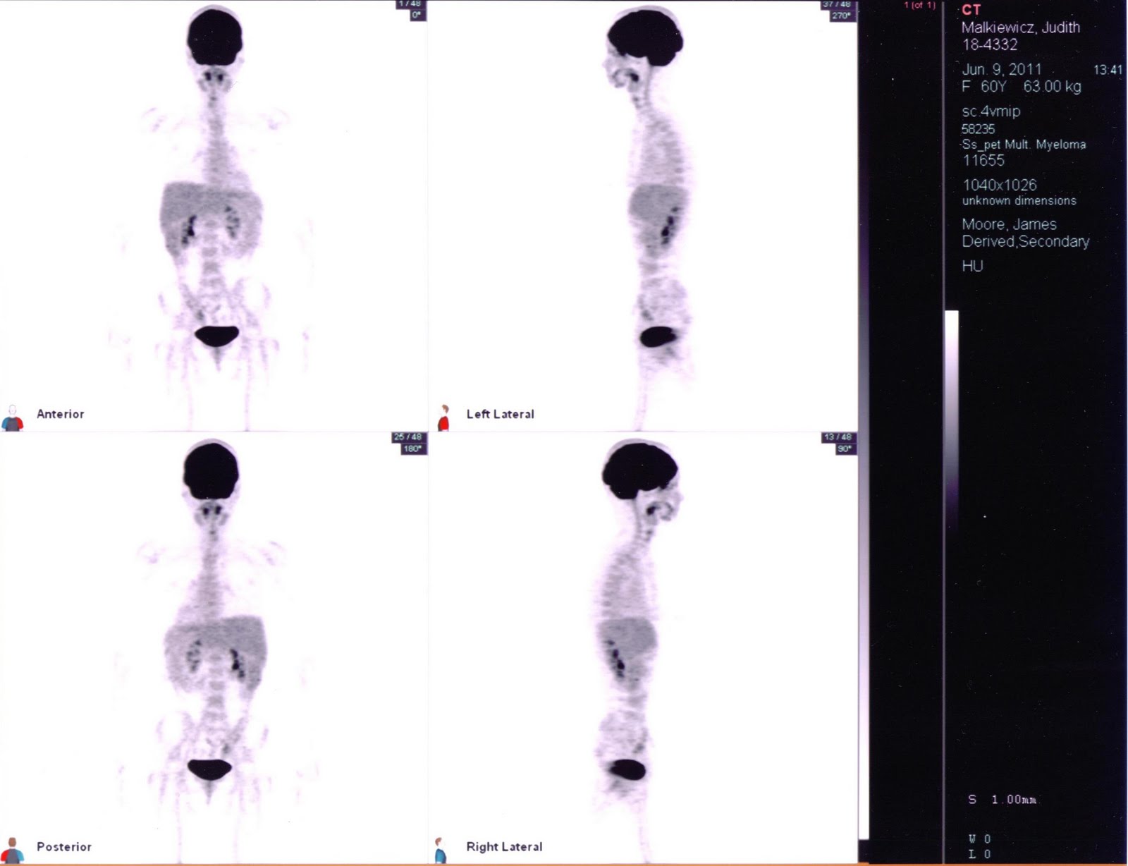 jm's Adventure with Multiple Myeloma: Dr. Moore Appointment and PET ...
