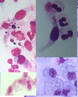 Citograma : Mastocitos en Acción, el Moco Nasal