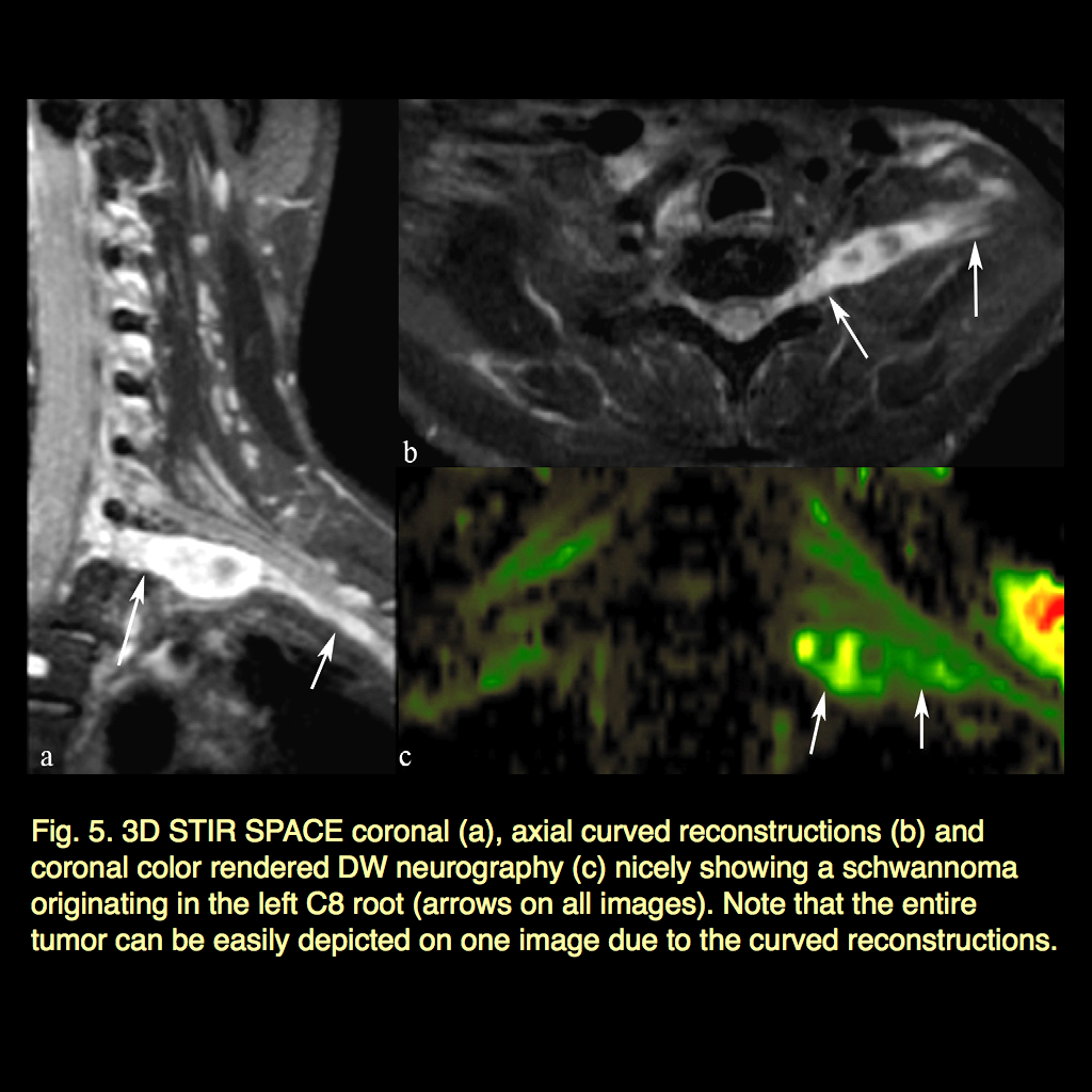 MRI BLOG: Brachial Plexus MRI (II/II)
