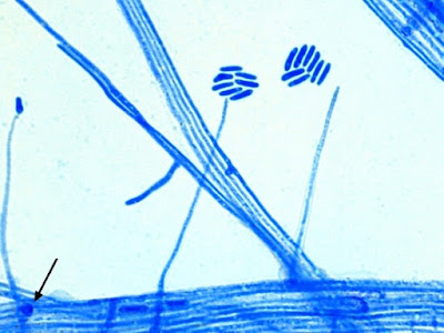 Fun With Microbiology (What's Buggin' You?): Sarocladium kiliense