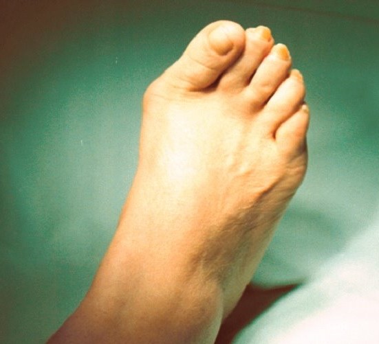 Podo Basas al Día: Austin con aguja reabsorbible. Hallux valgus con ...