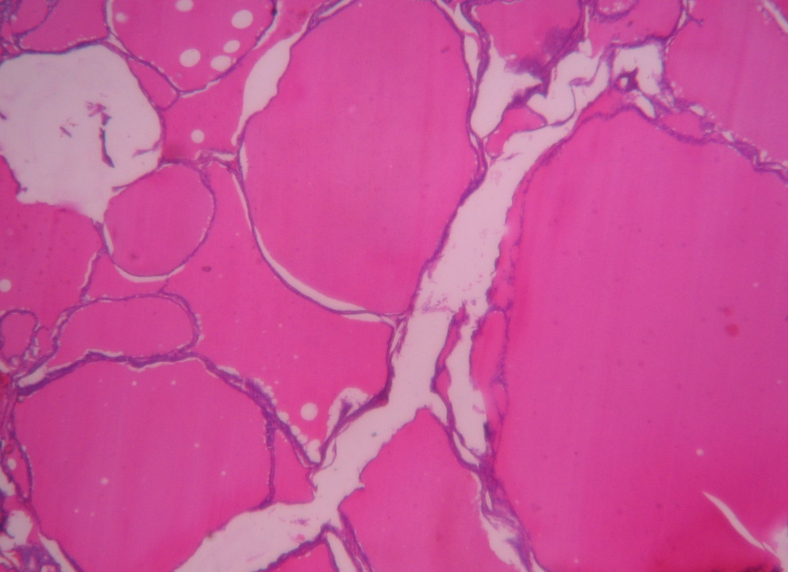 into the roots: Some thyroid lesions