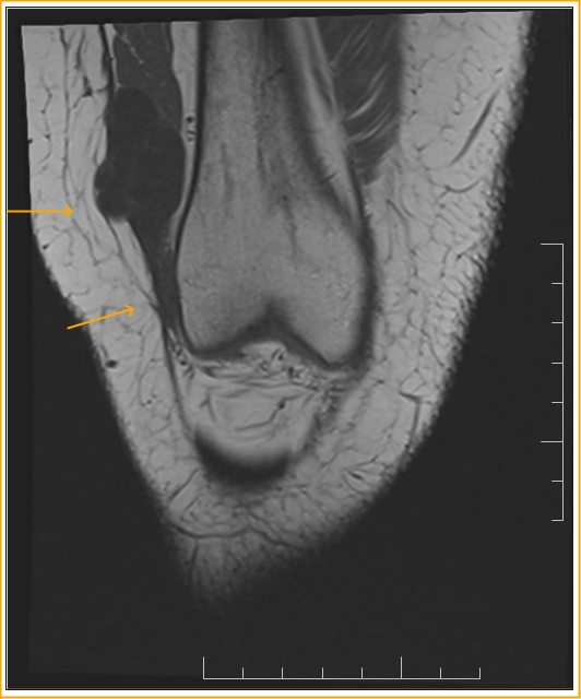 Iliotibial Band Syndrome-MRI - Sumer's Radiology Blog