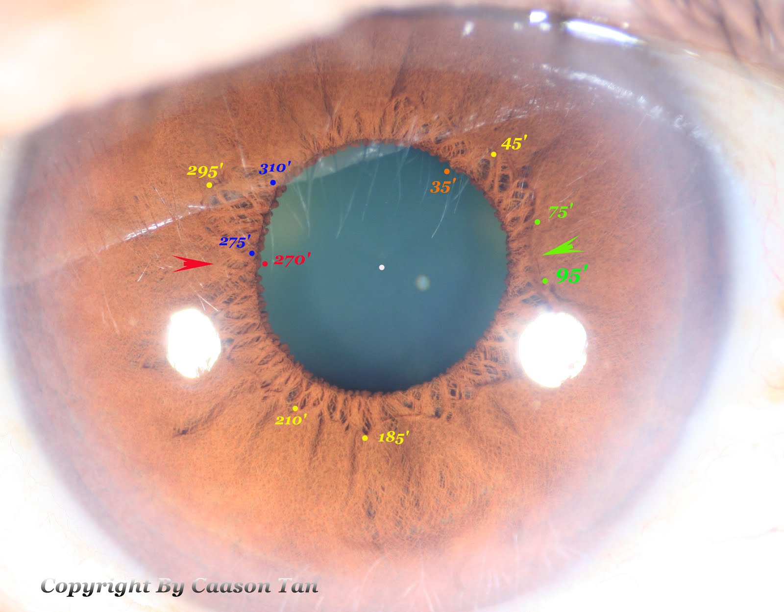 Modern & Multidimensional Iridology: Localised Absence of the IPB ...