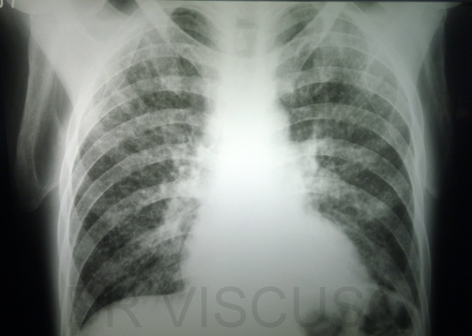 SÍNDROME DE LOEFFLER: SÍNDROME DE LOEFFLER