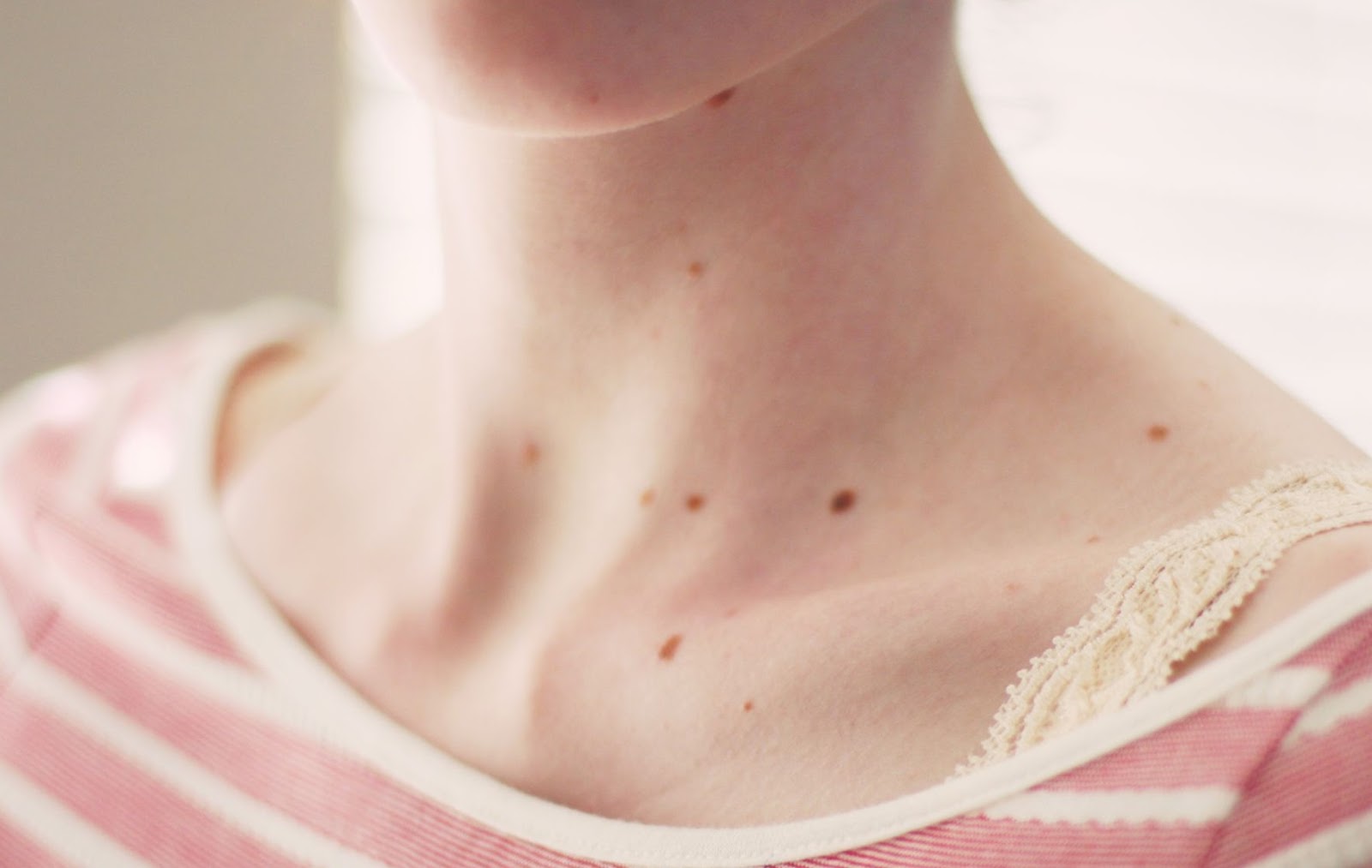 Photos of Moles on Face and Neck ~ How To Remove Moles, Warts, Skin ...