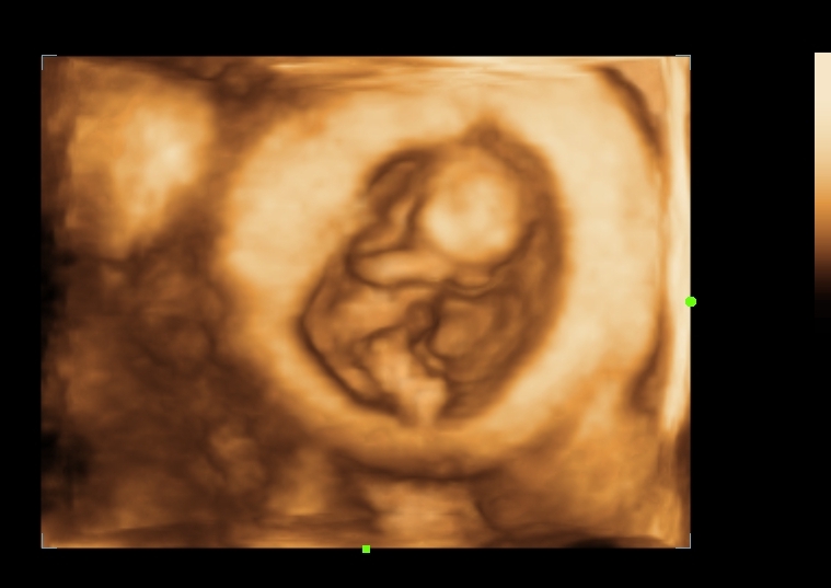 BANGALORE ULTRASOUND BLOG: 3D/4D scan for pregnancy