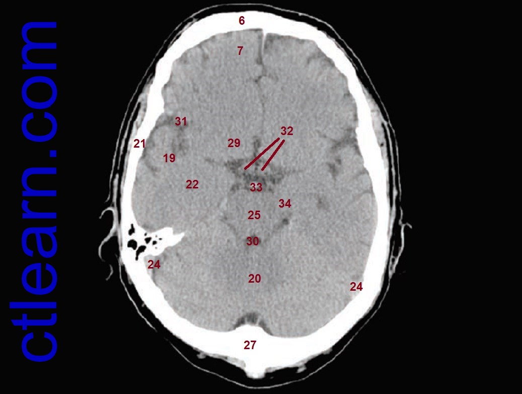 Anatomy CT Axial Brain