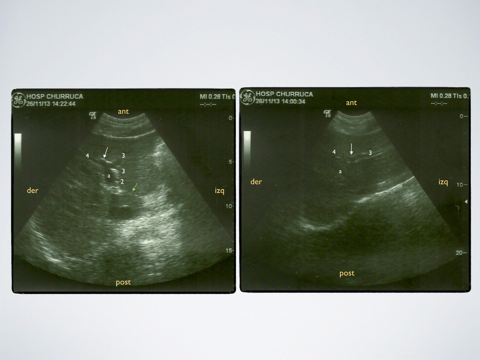 Cuadernos de Anatomía Quirúrgica: Segmentación hepática en ecografía.