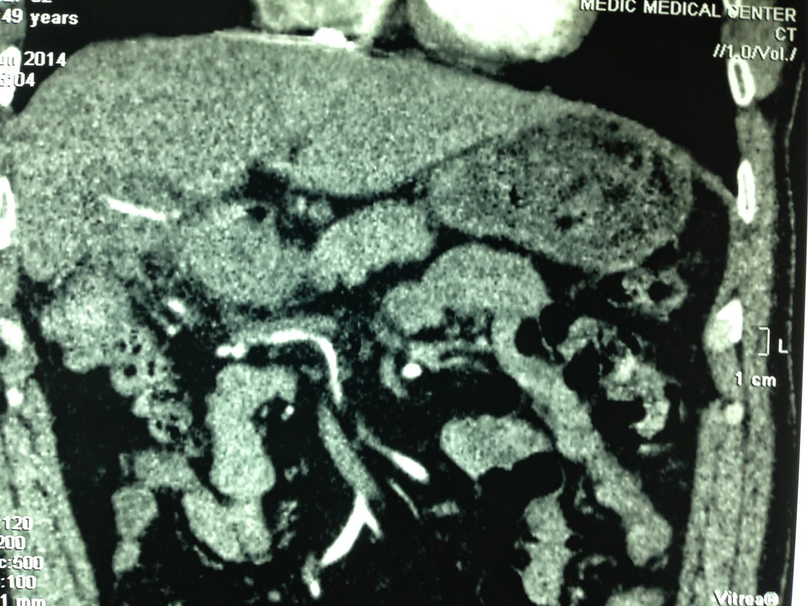 VIETNAMESE MEDIC ULTRASOUND: CASE 265: FISH BONE IN GALLBLADDER: Dr ...