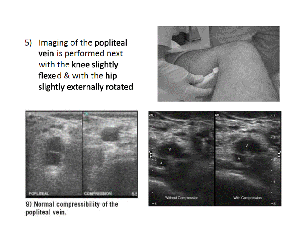 BÀI SOẠN VỀ SIÊU ÂM CHẨN ĐOÁN: Acute and Chronic DVT and Ultrasound (US)