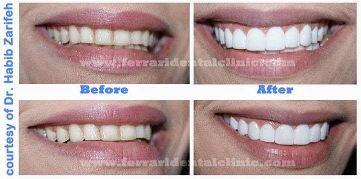 Cosmetic dentistry Lebanon by Dr.Habib Zarifeh the Lumineers veneers ...