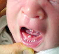 ~BABY CLINIK~: what is natal teeth and when to remove it