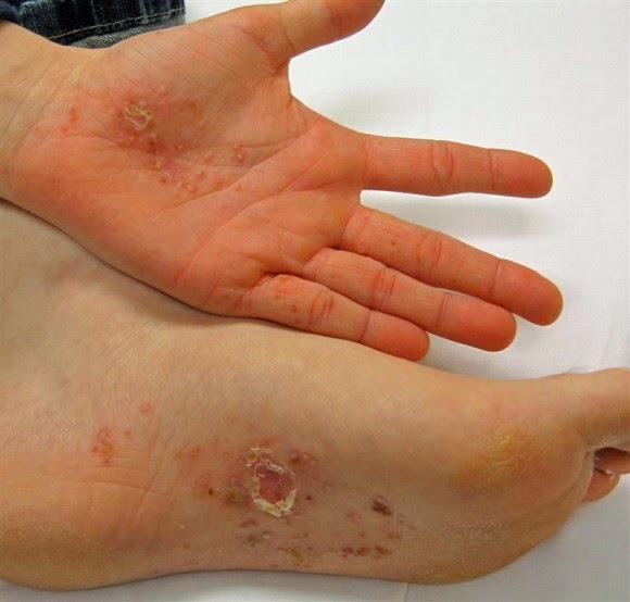 Learn Types Of Eczema: Dyshidrotic Eczema