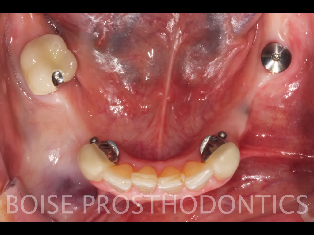 Boise Idaho Prosthodontics: Maxillary Teeth and Mandibular Semi ...