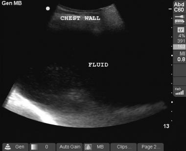 Dr. Saif ALaa ALqaisy: lung thoracentesis puncture site and technique