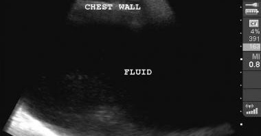 Dr. Saif ALaa ALqaisy: lung thoracentesis puncture site and technique