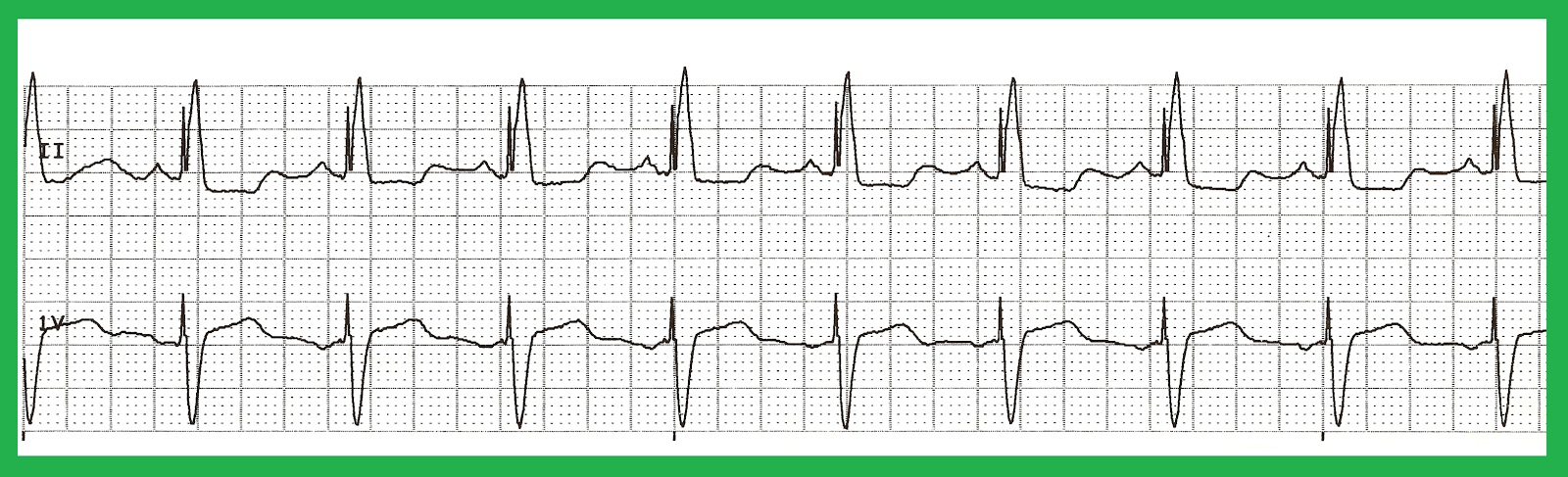 Various Ventricular Paced Rhythms
