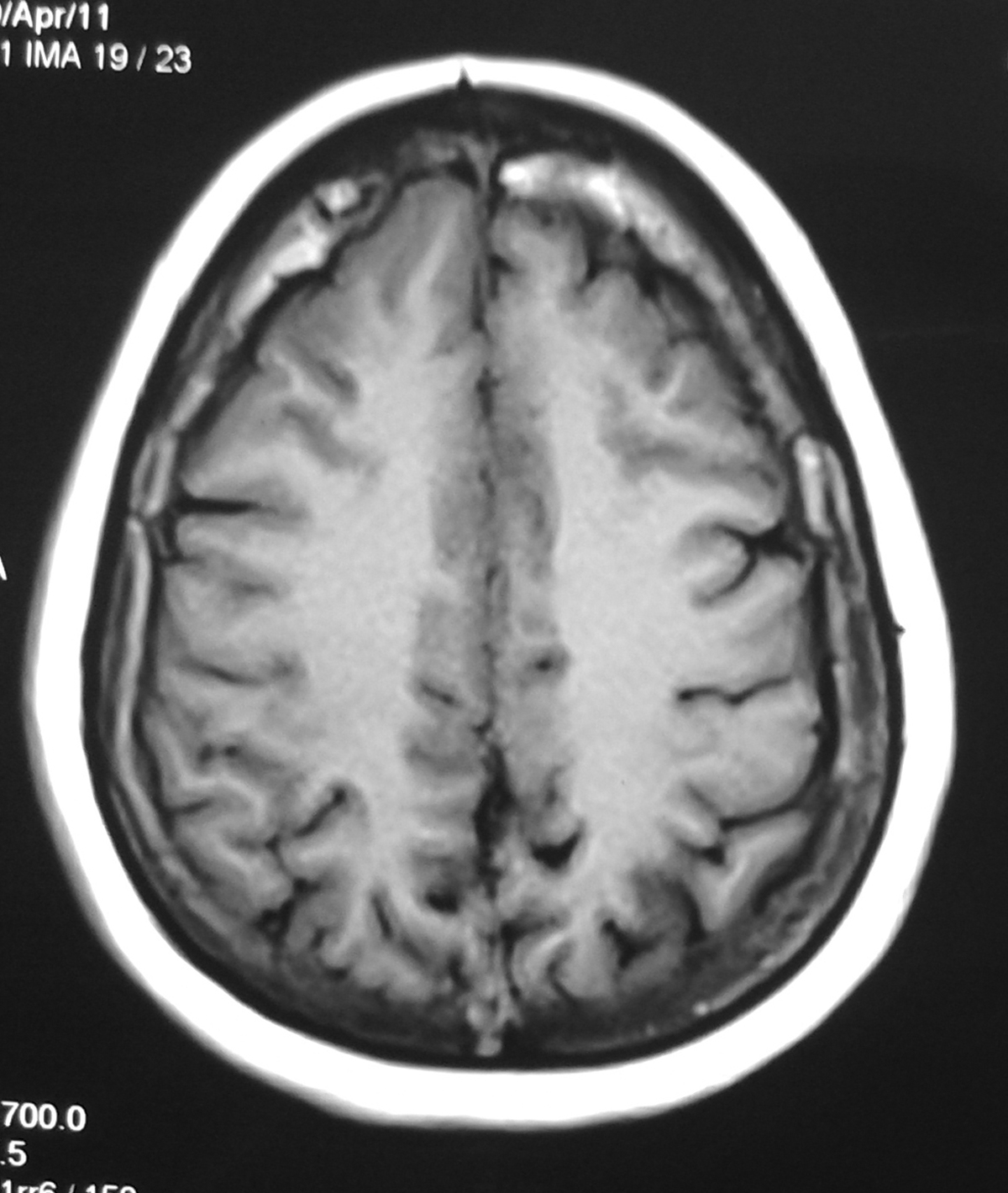 Radiodiagnosis - Imaging is Amazing-Interesting cases: Calvarial ...