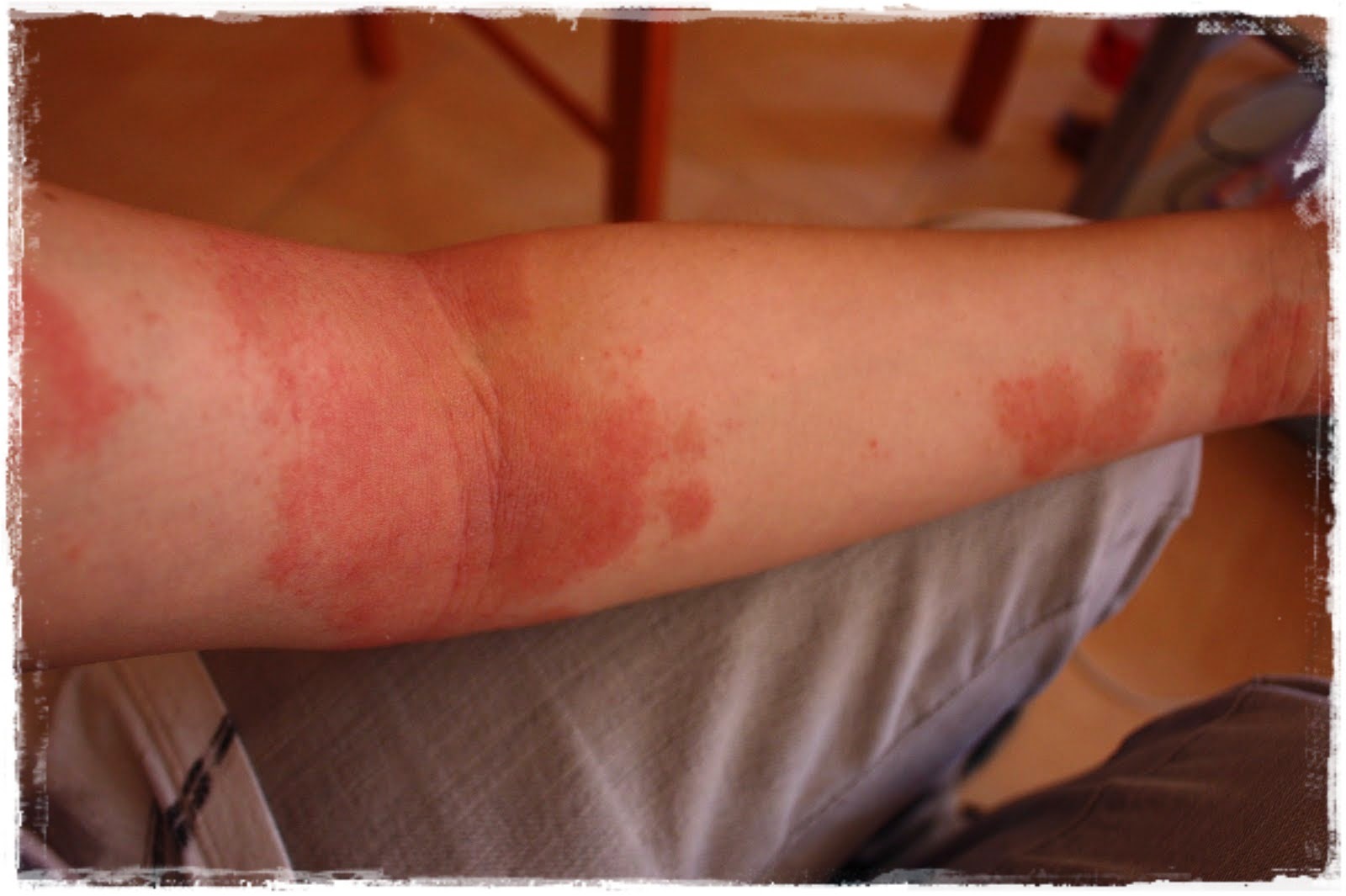 ¿Cómo controlar la dermatitis atópica? | Con P de Pediatría