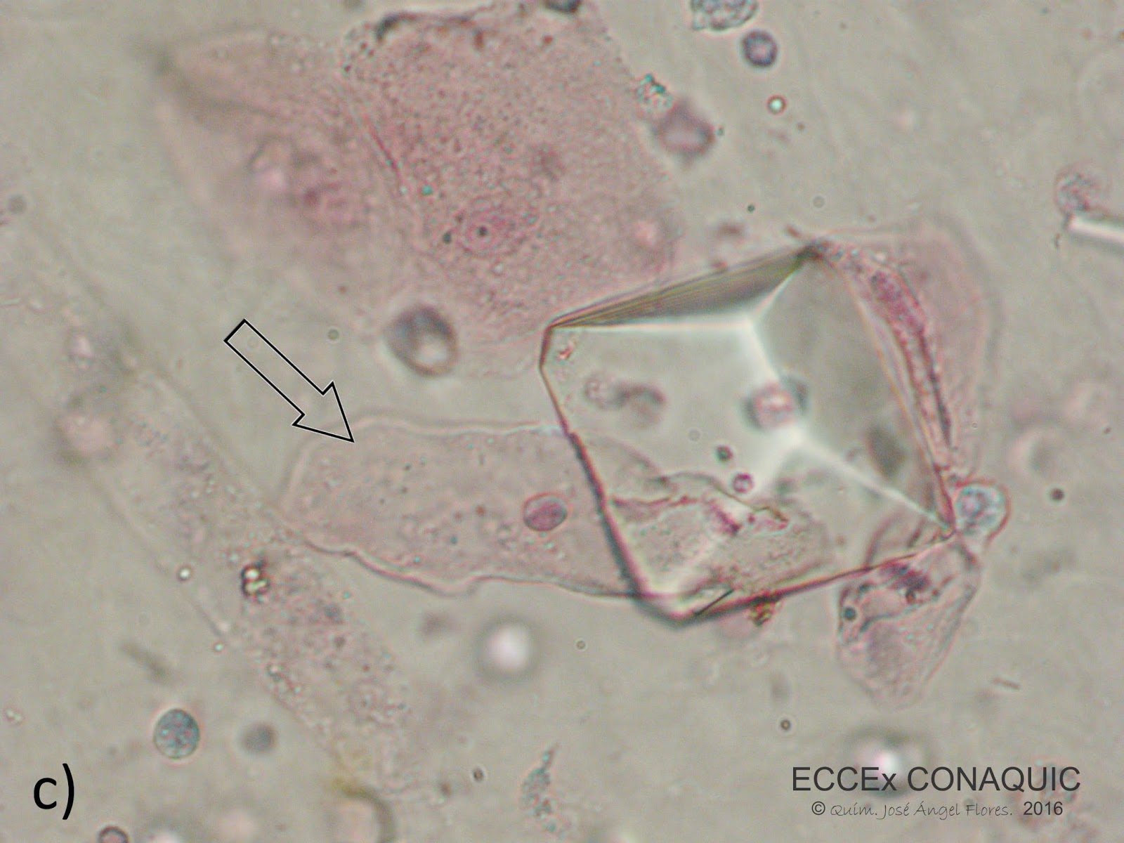 Caso UR-agosto-16 (Enfoque: Cristaluria)