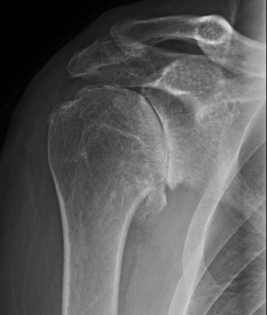 Shoulder Arthritis / Rotator Cuff Tears: causes of shoulder pain: What ...