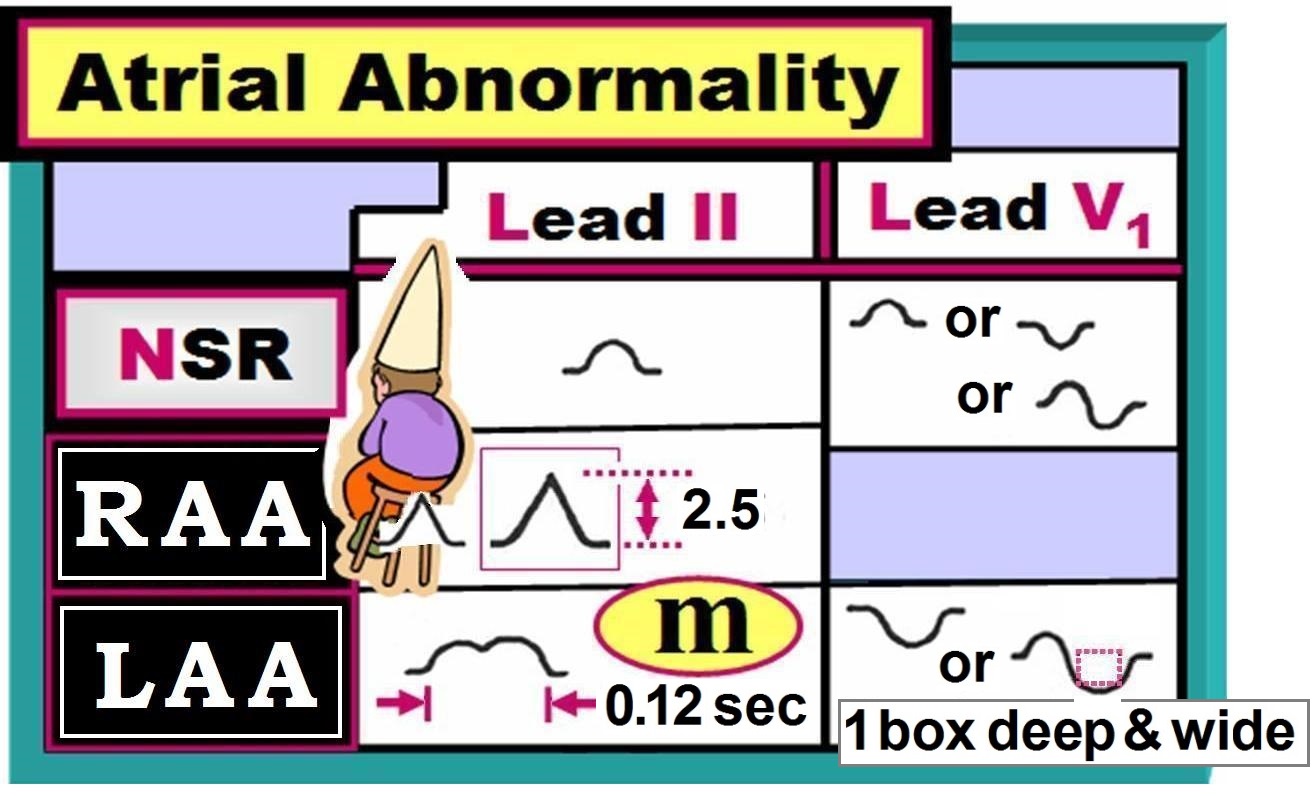 ECG Interpretation: ECG Blog #75 — LAA vs LAE vs Not ...