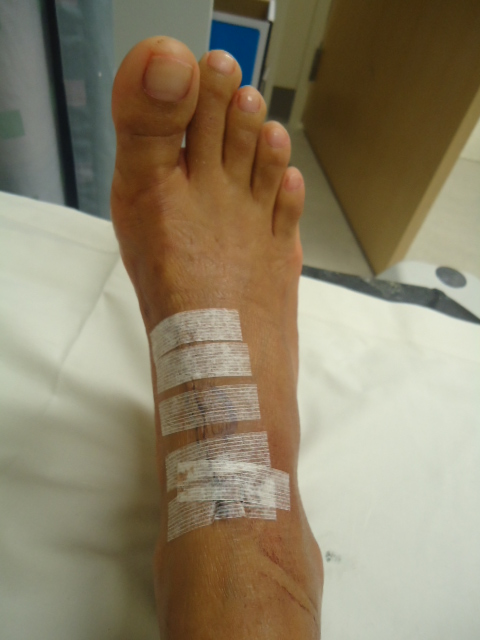The Zipperfoot Journals: Severed EHL Tendon: 6 Week Post-Op