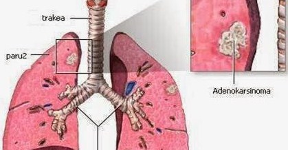 Cara Mengobati Abses Paru Paru Secara Alami ~ Cara Menghilangkan ...