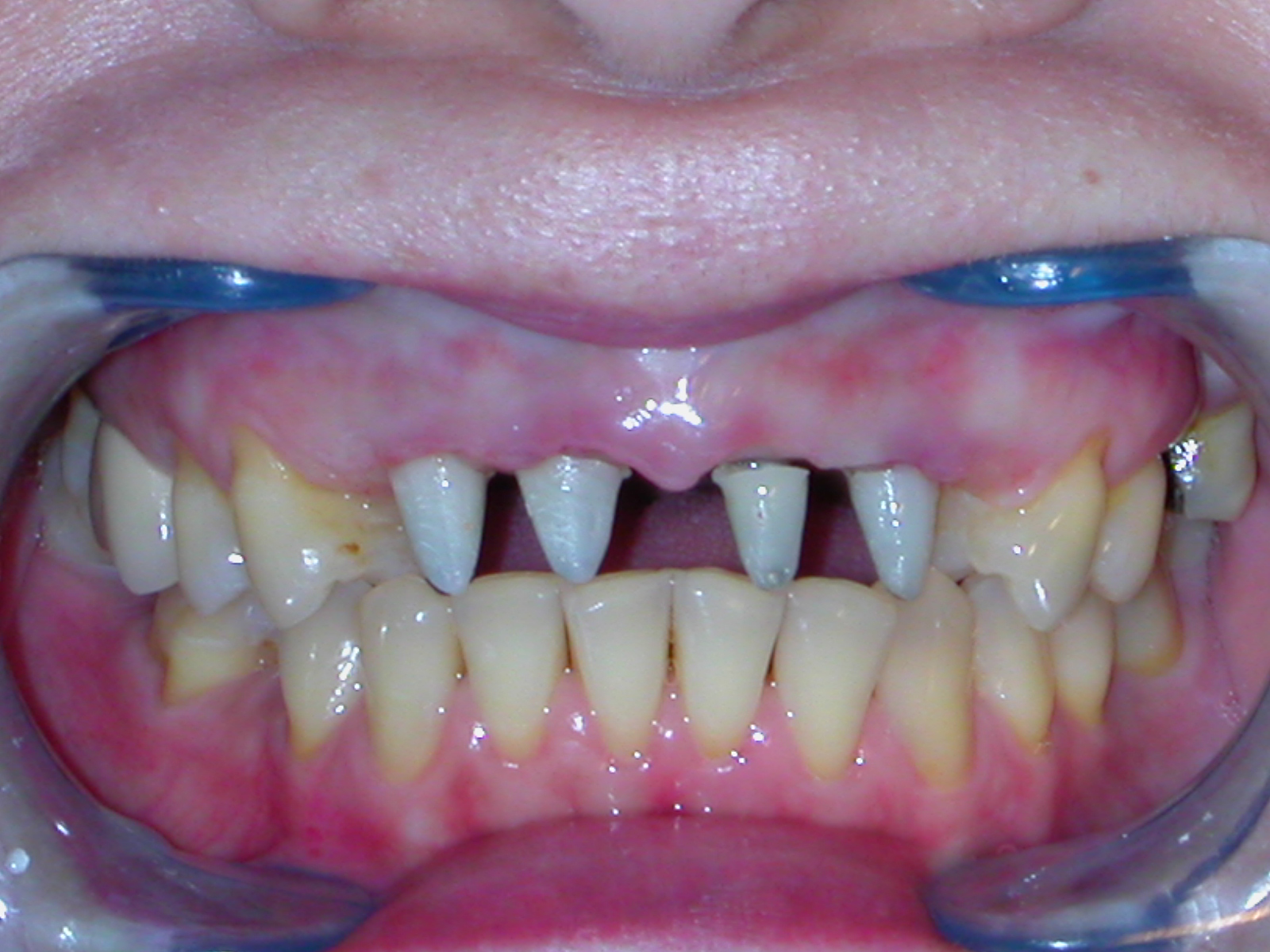 Dental Implantology: MISSING UPPER FRONT TEETH: GRAFT FREE TREATMENT OF ...