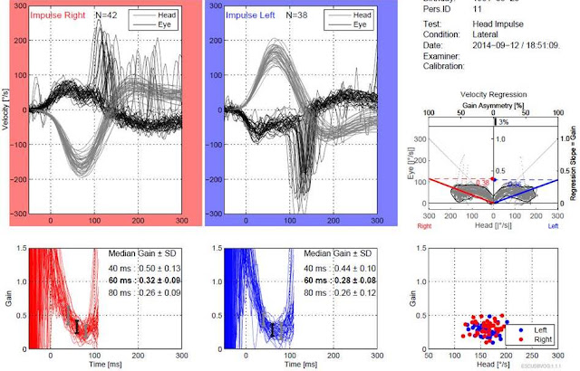 Neurociencias de la memoria y del equilibrio: DESEQUILIBRIO E ...