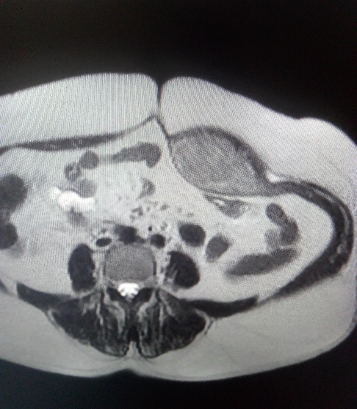 Abdominal wall mass –MRI Approach - Sumer's Radiology Blog