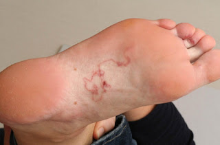 Hookworm Rash Pictures | Medical Pictures and Images - (2018 Updated)
