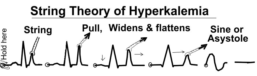 [전공의] 고칼륨혈증, 심전도, Hyperkalemia, EKG : 네이버 블로그