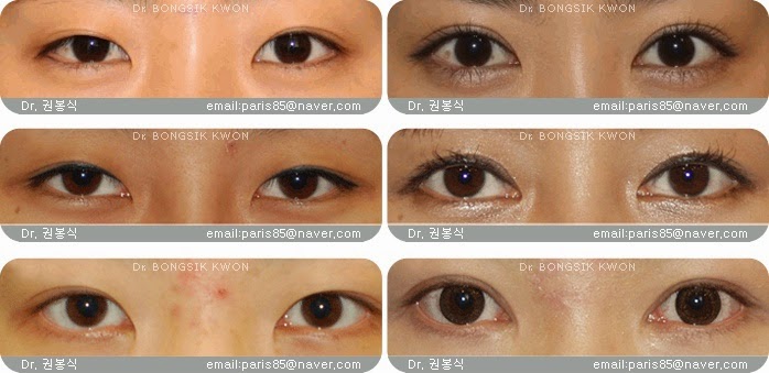 Teuim Aesthetic Plastic Surgical Clinic Dr.Kwon: The double eyelid