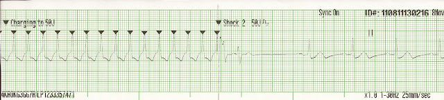 Float Nurse: Pediatric Advance Life Support: SVT Part 6
