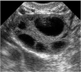 The IVF Specialist's Blog for IVF patients: The difference between ...