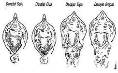 MAKALAH RUOBEKAN PERINEUM | PESONA CERDAS