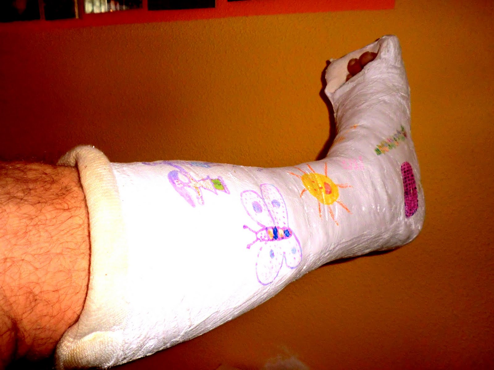 MMéndezM: LESION FRACTURA PERONE