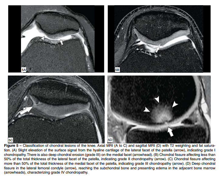 MRI OF KNEE