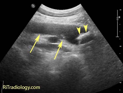 RiT radiology: Pyonephrosis