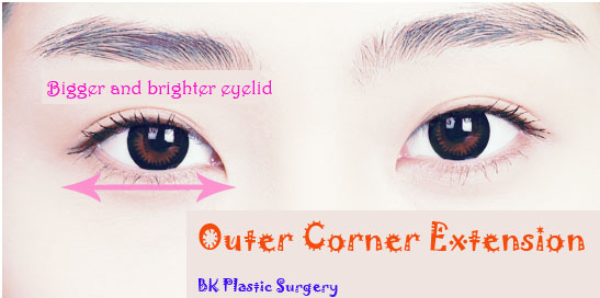 BK Plastic Surgery: [BK Plastic Surgery] Outer Corner Extension