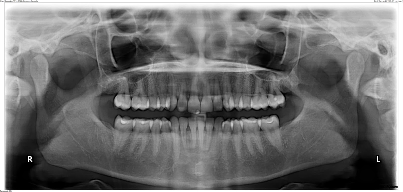 Toronto Invisalign - Brand New Smile :): Interproximal Reduction (IPR ...