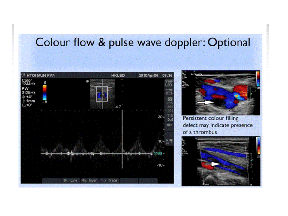 BÀI SOẠN VỀ SIÊU ÂM CHẨN ĐOÁN: Acute and Chronic DVT and Ultrasound (US)