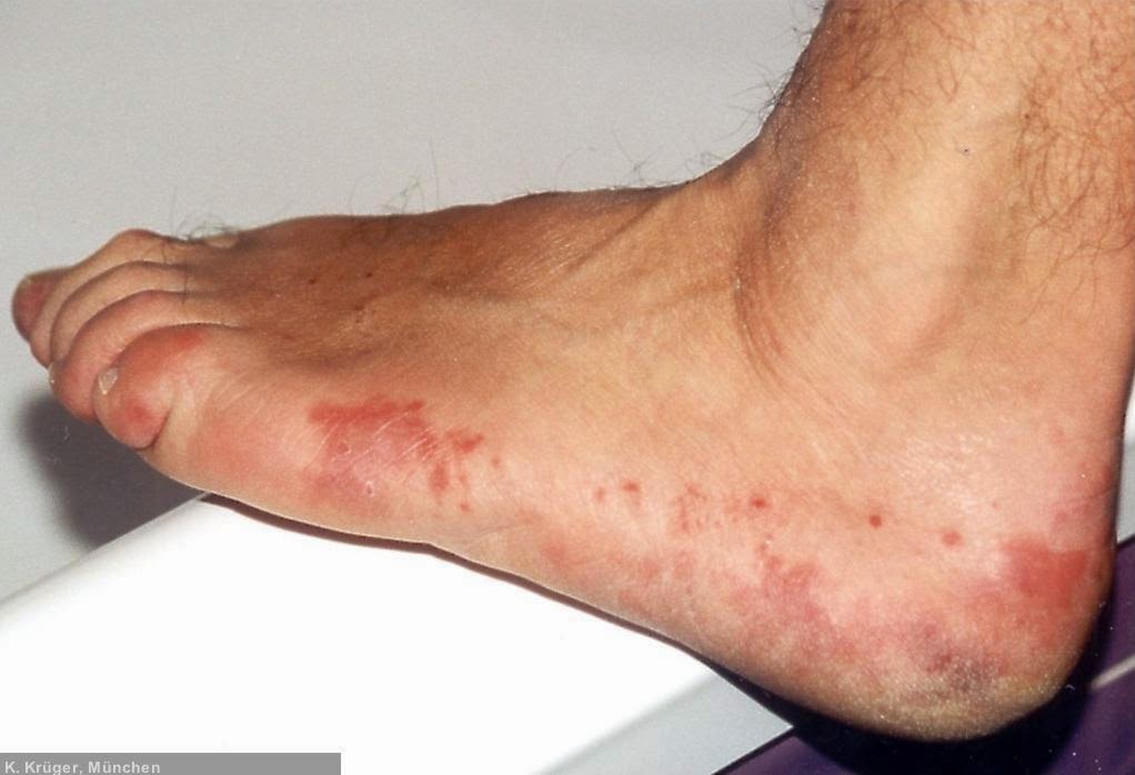 Pengobatan Alami Untuk Vaskulitis | Kumpulan Tips Kesehatan Bermanfaat