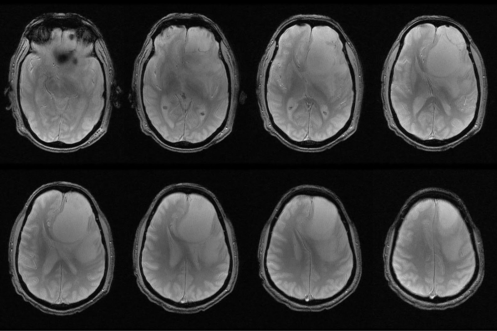 Dr Balaji Anvekar FRCR: Frontal SOL, Guess Histopathology