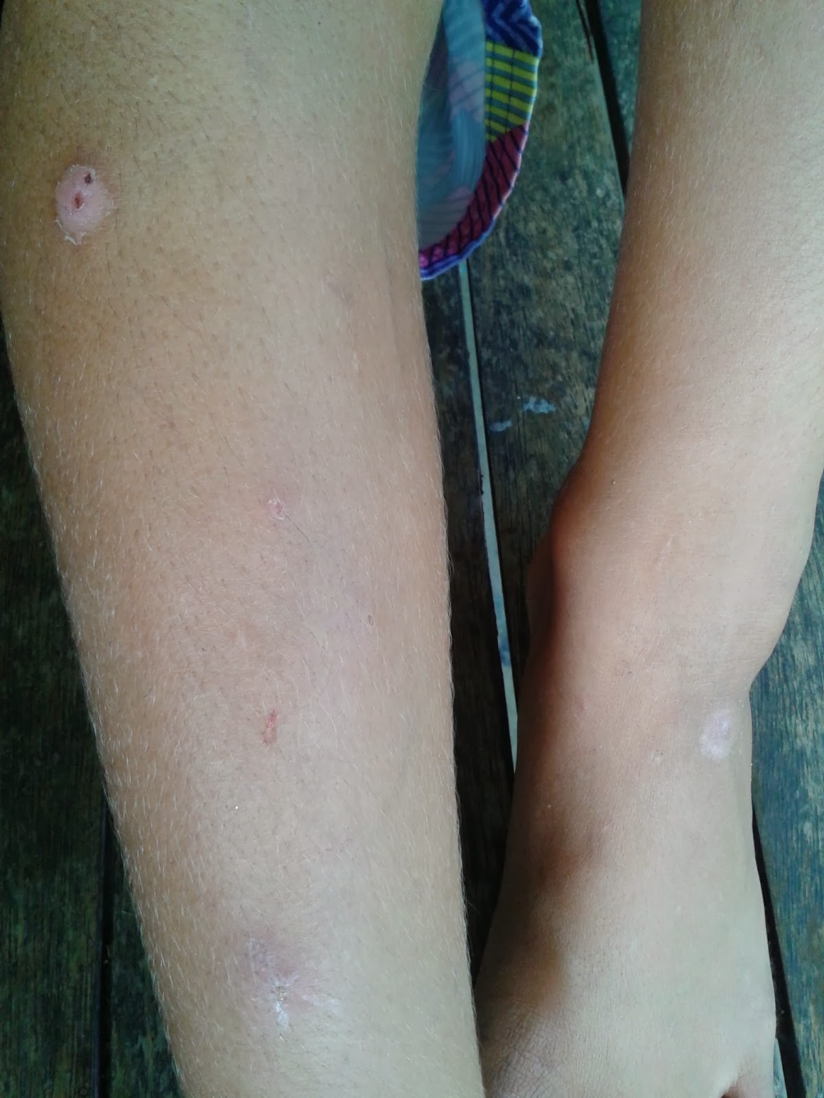 Ilan Life: 'Tis the season for staph and streptococcus