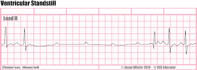 ECG Educator Blog : Ventricular Standstill
