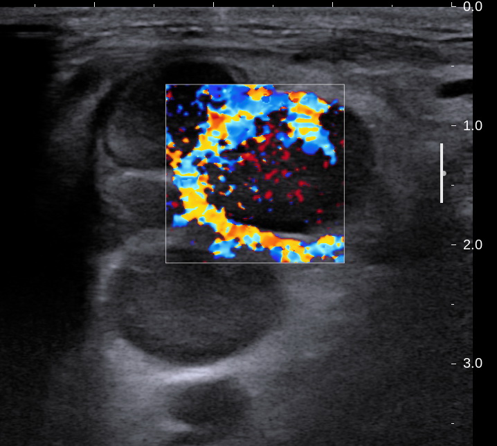 VIETNAMESE MEDIC ULTRASOUND: CASE 470: TROISIER-VIRCHOW NODES, Dr PHAN ...