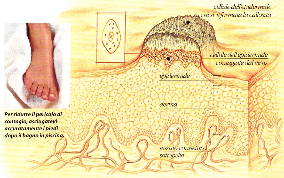 CURARE LE VERRUCHE - Blog di pociopocio